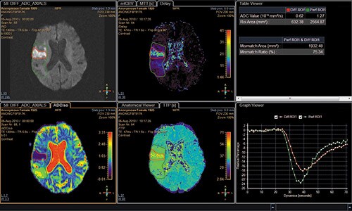 Magnetresonanztomographie (MRT) | Philips Healthcare