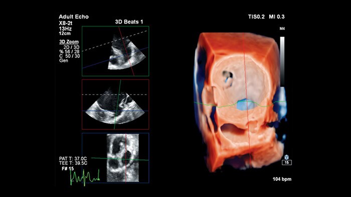 Echokardiographiegeräte Ultraschall In Der Kardiologie Philips